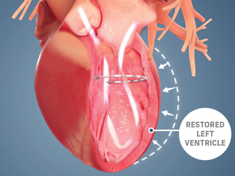 CAMC Enrolls Heart Failure Patients in Study for New Treatment Option ...